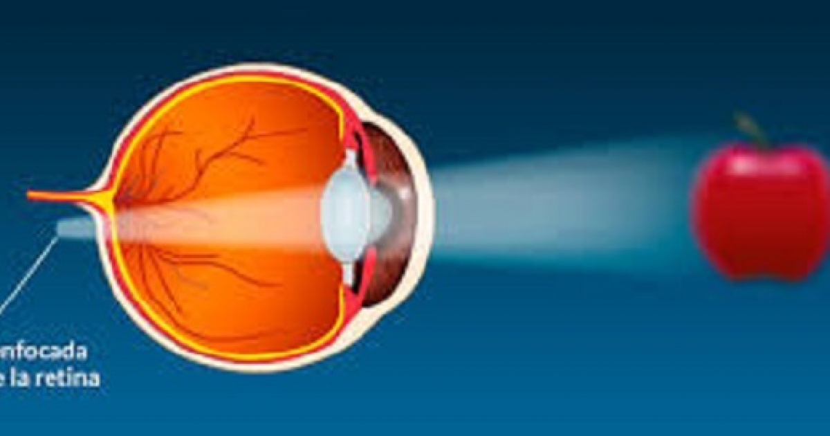 Hipermetropía o hiperopia